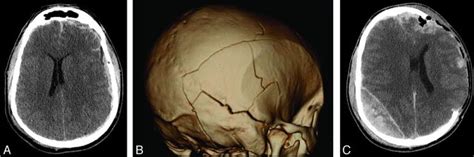Calvarial Fracture Patterns On Ct Imaging Predict Risk Of A Delayed Epidural Hematoma Following