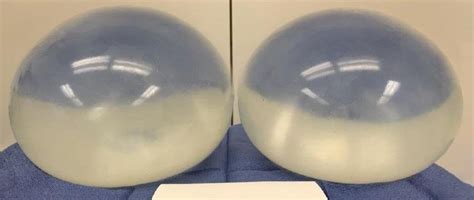 4000cc Breast Implants Rweird