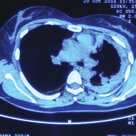 Causes Of Diffuse Pleural Thickening Download Table