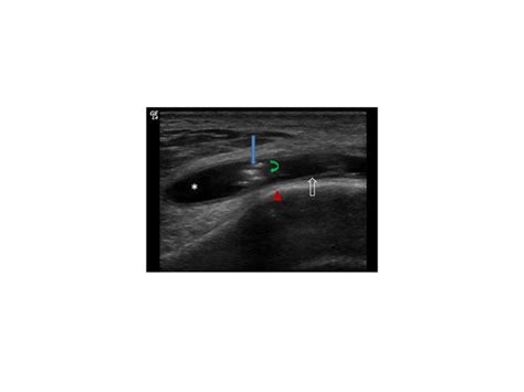 Cppd Arthropathy Rheumatology Advisor