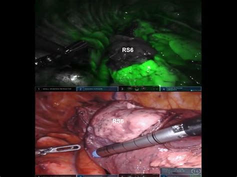 Rs6 Segmentectomy The Intersegmental Fissure Between The Rs6 Superior Download Scientific