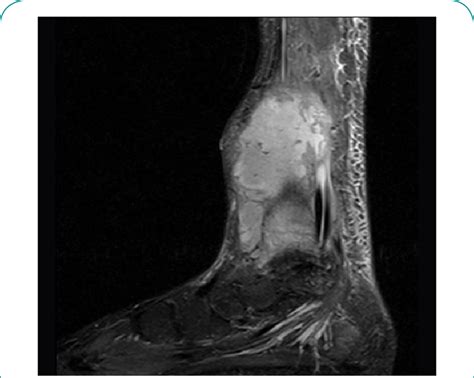 A Mri Of Left Tibia Extensive Soft Tissue Swelling Download