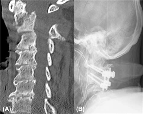 Odontoid Fracture Treatment Modality In Type Ii Odontoid Fractures