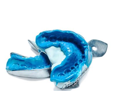 Are Teeth Molds For Braces Really Necessary Chicago Dental Implant