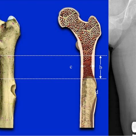 The Femoral Cortical Bone Bulges And The Prosthesis Penetrate The