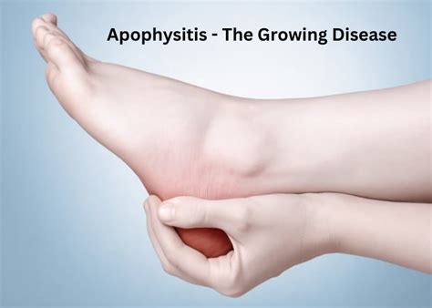 Apophysitis Understanding And Managing The Growing Disease