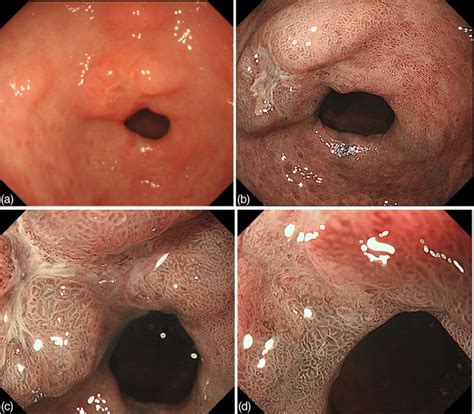 Egd Findings A An Irregular Depressed Lesion With A Protuberance