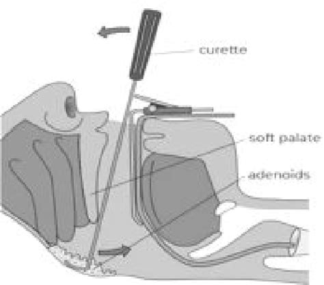 Diagrammatic Picture Of Adenoidectomy Download Scientific Diagram