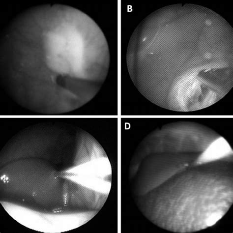 Healed Bladder Scar At Autopsy Download Scientific Diagram