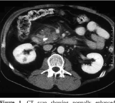 Figure 1 From Solitary Main Pancreatic Ductal Calculus Of Possible