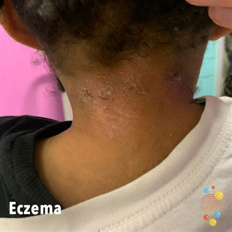 Eczema Skin Deep