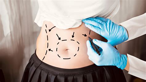 Mini Tummy Tuck Vs Full Tummy Tuck Your Complete Decision Guide