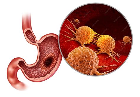 El Cáncer De Estómago Humano Y El Tumor Gástrico En El Sistema