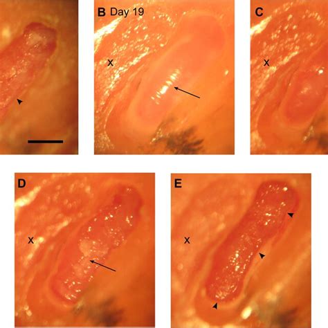 Overview Of A Progression Of A Craniotomy To Allow Access For The