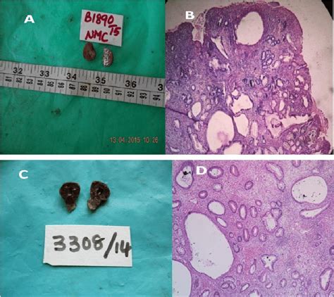 Photomicrograph Showing Juvenile Polyp And Hyperplastic Polyp A Gross