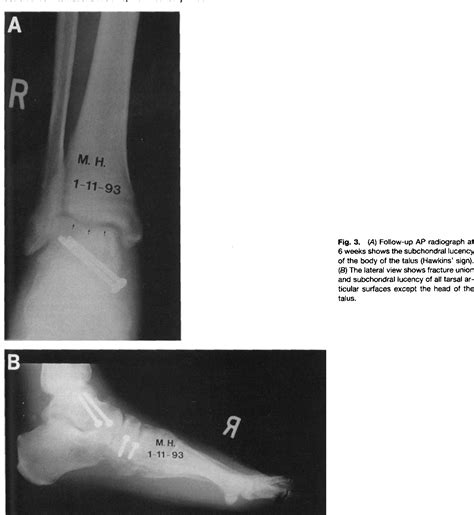 Figure 1 From Talar Neck Fracture With Talar Head Dislocation And