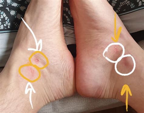 Anyone Recognizes Skin Tears At These Spots And Know How To Deal With