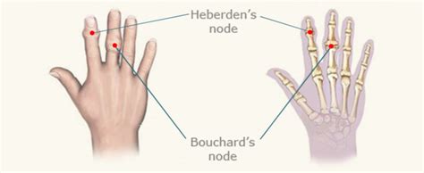 Osteoarthritis Treatment Miami Hand Center