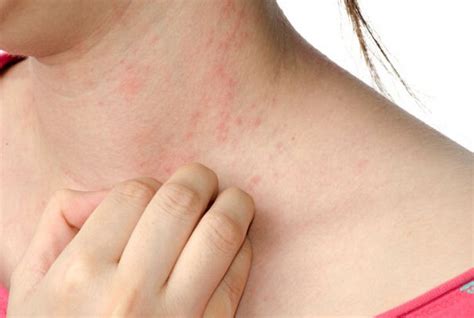 Itchy Red Bumps On Skin12 Common Causes With Treatment