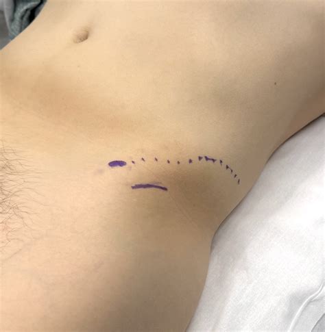 Left Iliac Crest Implant Incision Marking Obloique View Dr Barry Eppley
