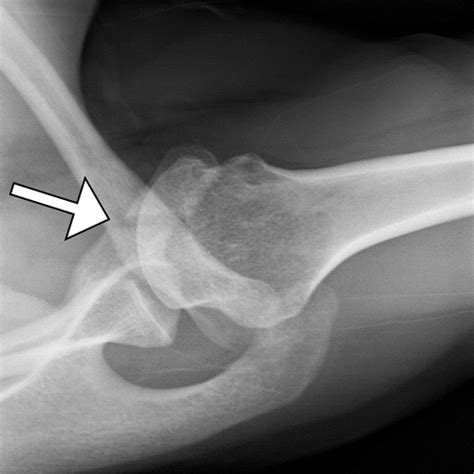 Coracoid Process X Ray