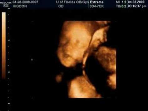 Twins At 28 Weeks 3d Ultrasound In Color Part 1 Youtube