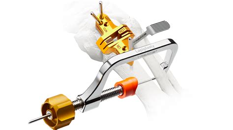 Lapiplasty® Compression Screws Treace