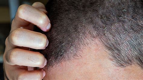 Scaling Skin Pictures Causes Diagnosis And Treatment