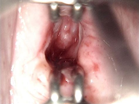 Atlas De Colposcopia Principios Y Práctica