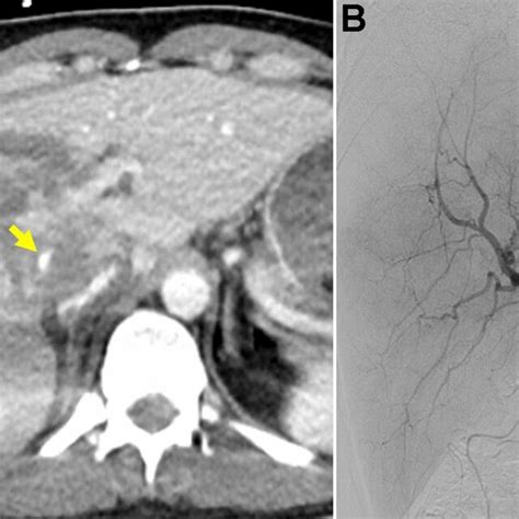 23 Year Old Male Pedestrian Struck A Ct Shows Grade 4 Hepatic