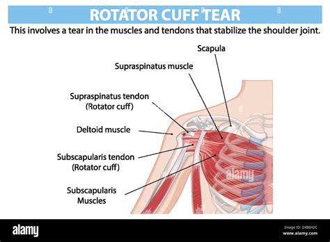 Detailed Anatomy Of Shoulder Rotator Cuff Tear Stock Vector Image And Art
