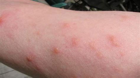 Poison Ivy Rash Fact About Rash Symptoms And Treatment