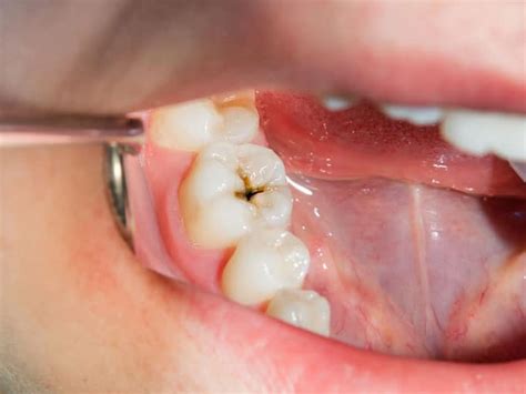 Soñar Con Muela Con Hueco