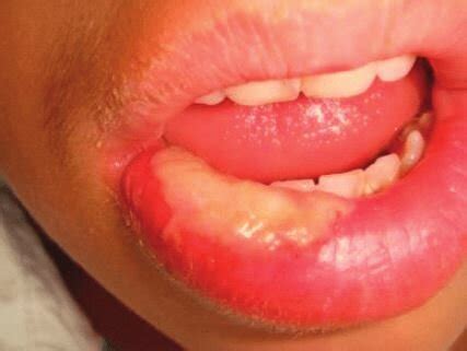 Why My Lips Going Numb Lipstutorial Org