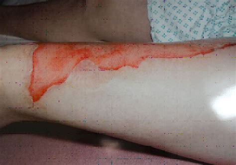 Surgeons Issue Warning On Dangers Of Exploding E Cigarettes The