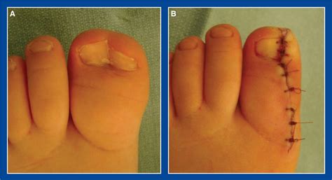 Foot Malformations Musculoskeletal Key