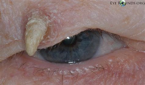 Squamous Cell Carcinoma Of Skin