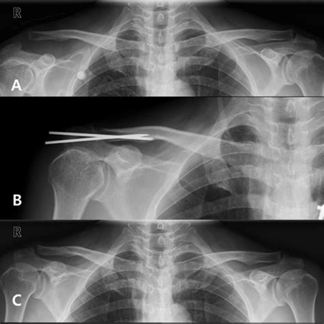 A Type V Ac Dislocation By Rockwood Classification B Ac Joint