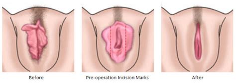 The Health Website Labiaplasty Vulval Surgery