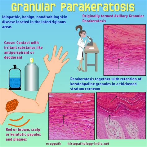 Sebaceous Cyst Icd 10 Edgarabbhayden