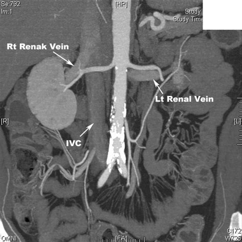 Inferior Vena Cava