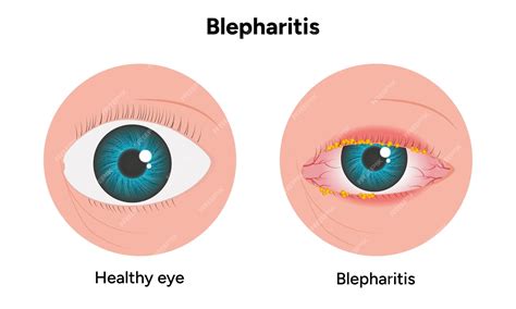 Premium Vector Blepharitis Eye Disease Ophthalmology Inflamed Sick