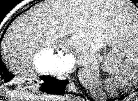 Diagnose Amblyopia With Caution