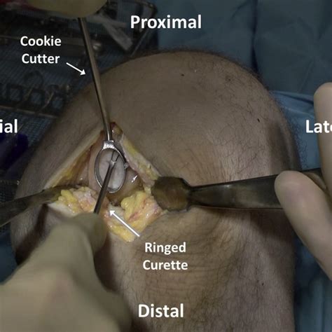 The Focal Cartilage Defect Is Debrided Using A Ringed Curette Which Is Download Scientific