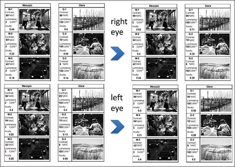 Vitrectomy For Vitreous Floaters Retinal Physician