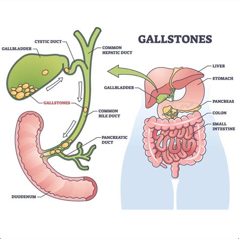 What Are Gallbladder Stones And What Causes Them To Form By Dranandnagar Jul 2024 Medium