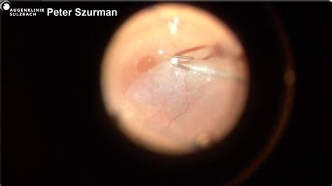 Epiretinal Lyophilized Amniotic Patch For Persistent Macular Hole Youtube
