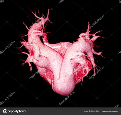 Pulmonary Trunk Branches