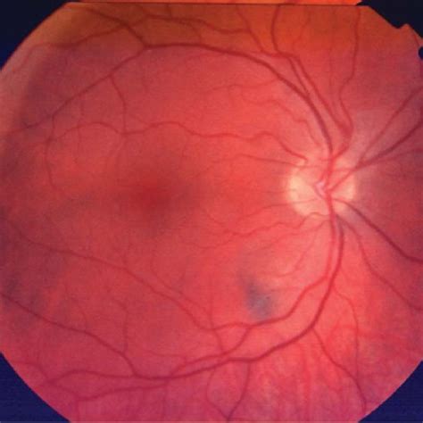 Appearance Of The Lesion 5 Years Later A Peripapillary Diffuse Download Scientific Diagram