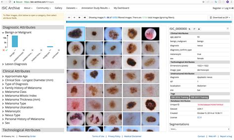 A Gentle Introduction To Machine Learning — Classification Of Malignant Melanoma And Benign Skin